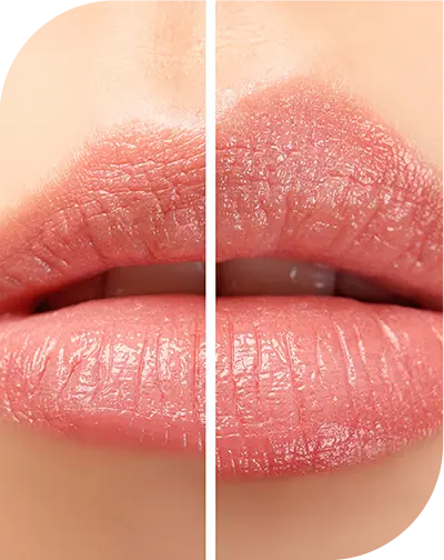 Bowtie Lips Treatment NYC | Syra Aesthetics™
