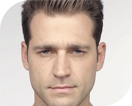 11's / Frown Lines Treatment in NYC | Syra Aesthetics™