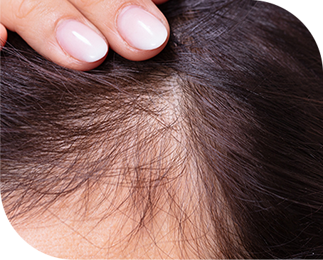 Microneedling with PEP - Hair | Syra Aesthetics