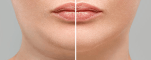 Botox For Jowls - Treatment, Before and After, Alternative, Costs