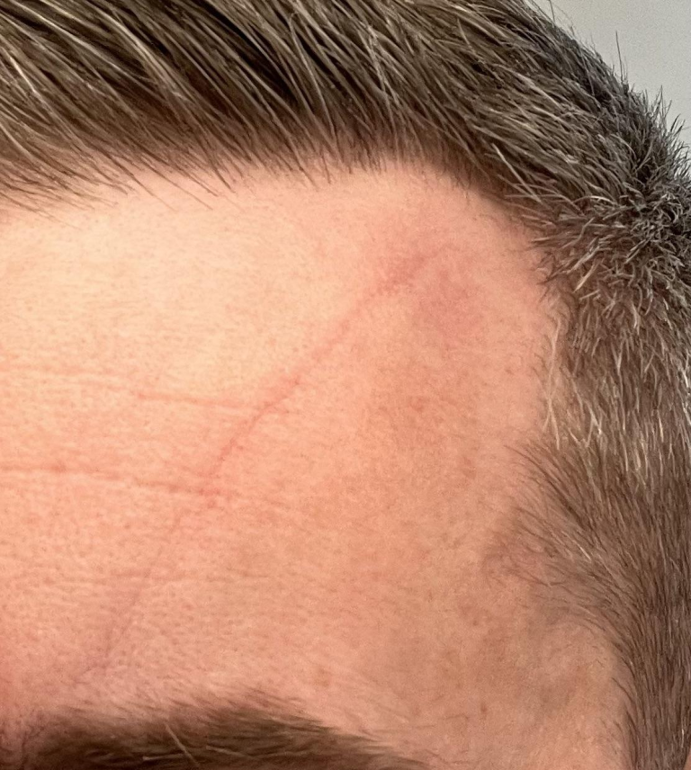 How to Treat Vertical Lines on Forehead: Causes, Prevention, and Best ...