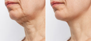 Botox For Jowls – Before and After, Treatments, How It Lifts, Costs