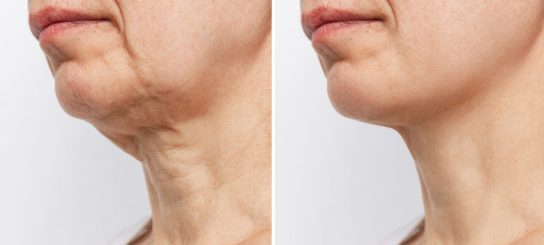 Botox For Jowls – Before and After, Treatments, How It Lifts, Costs