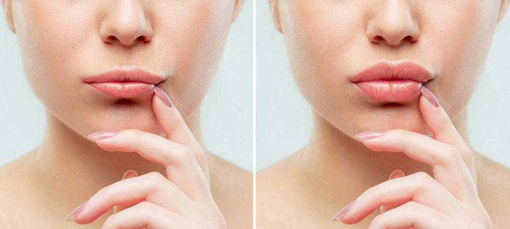 Juvederm vs. Restylane Lips - Which One Is Better?