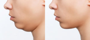 Botox For Jowls – Before and After, Treatments, How It Lifts, Costs