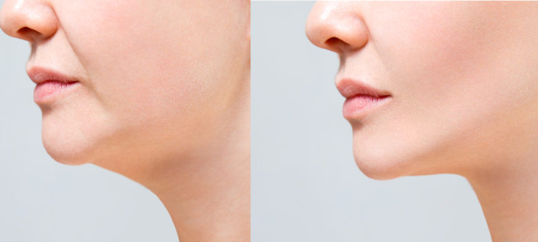 kybella before and after photos - What To Expect
