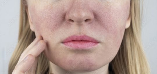 Pore No More: Tips and Tricks to Get Rid of Face Pores - Blog | SYRA ...