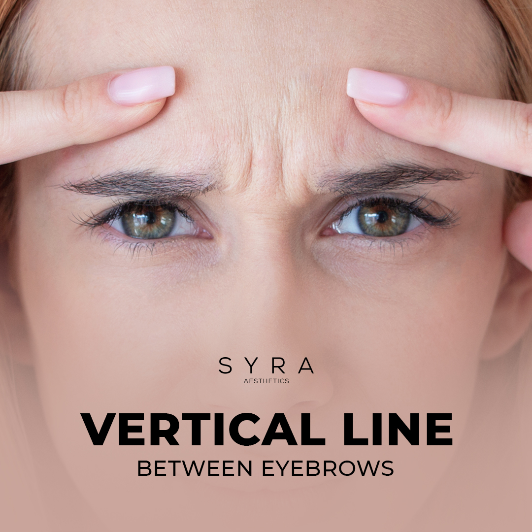 Key Facts About Vertical Line Between Eyebrows Key Facts About Vertical Line Between Eyebrows
