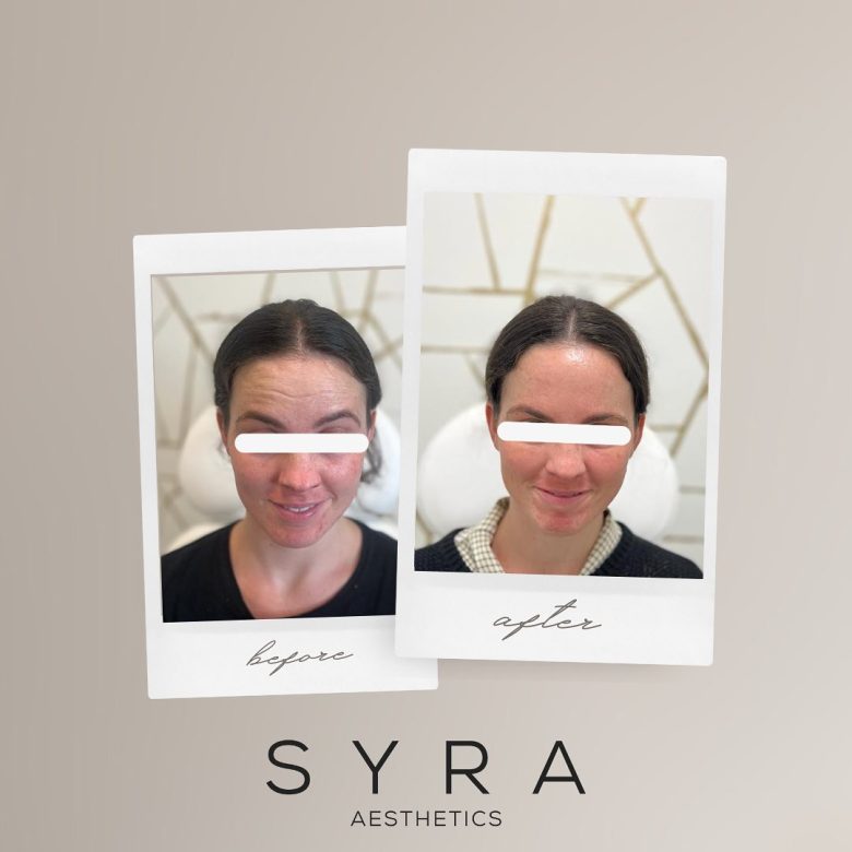 Jeuveau Vs Botox - How To Choose The Right Treatment