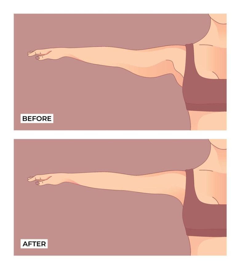 How to get rid of arm fat? Non surgical Fat Reduction, Procedures, And Cost